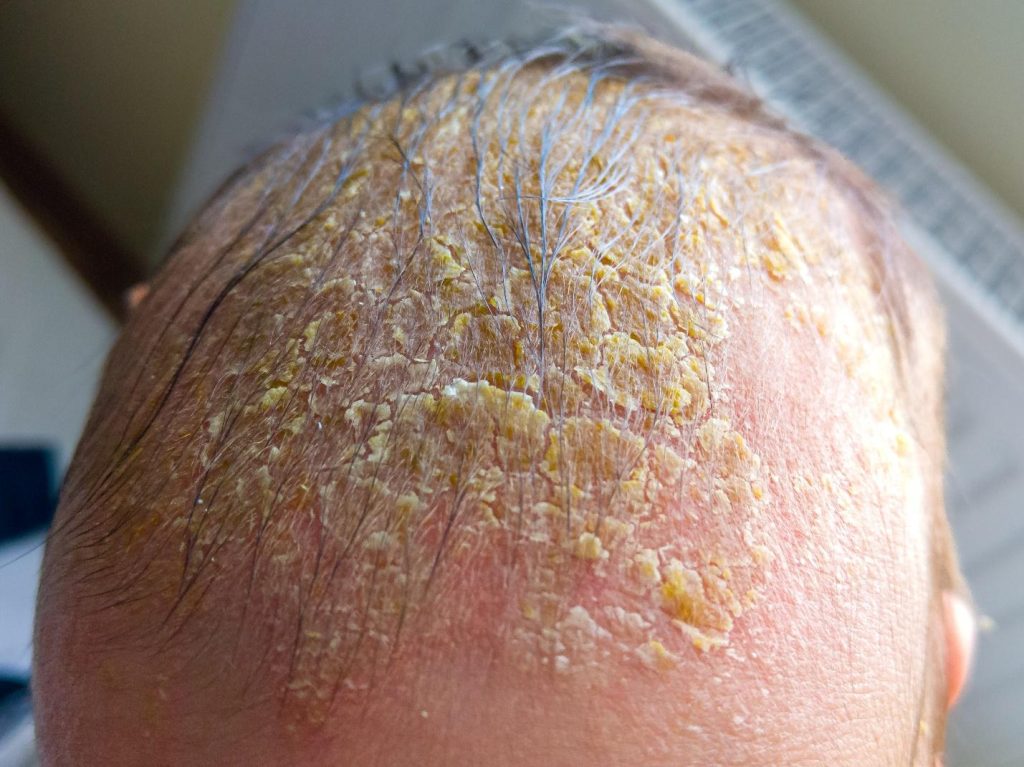 Newborn Rash - Livingstone Dermatology