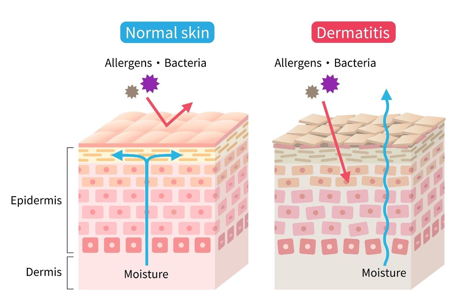 Acne Singapore: Tips for Managing Breakouts Singapore - Livingstone ...