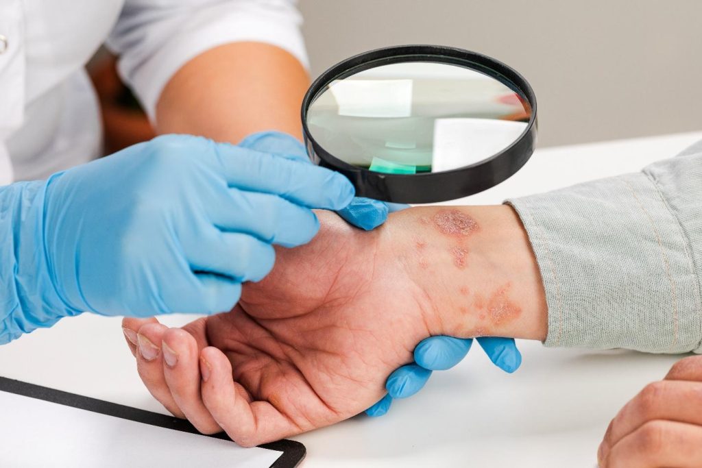 Psoriasis - Livingstone Dermatology