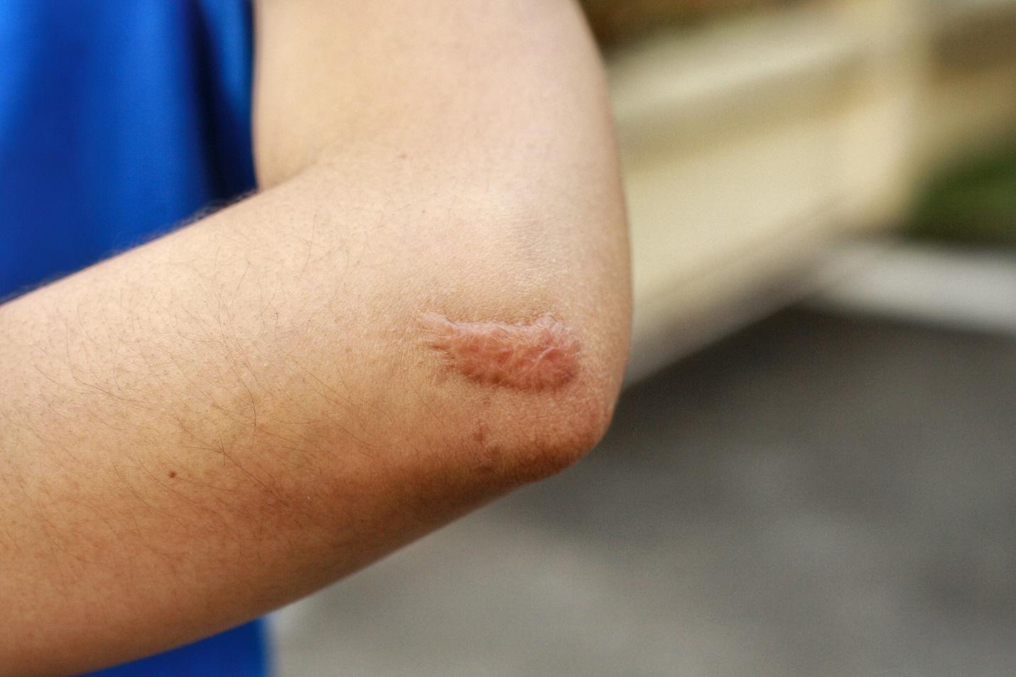 Keloid Scars - Livingstone Dermatology