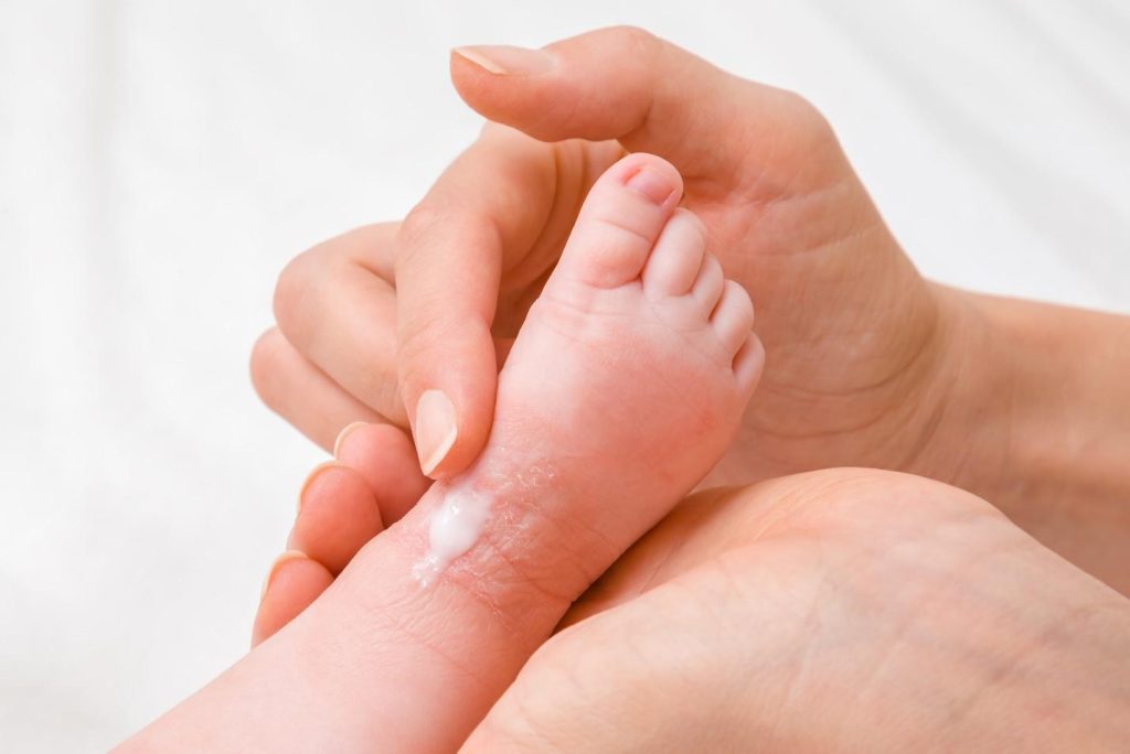 Newborn Rash - Livingstone Dermatology